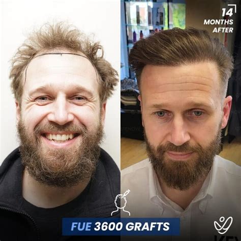 Diffuse Thinning Causes Symptoms And Treatment Options Estenove