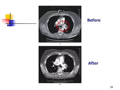 Pulmonary Embolism 1ppt