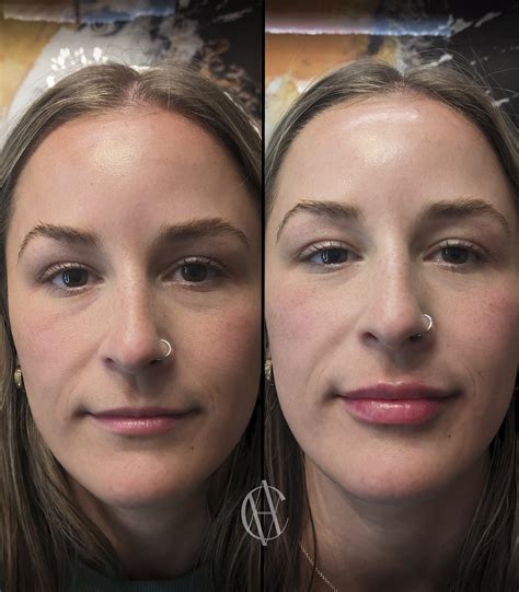 Lip Fillers At A Class Aesthetics Performing Advanced Injection