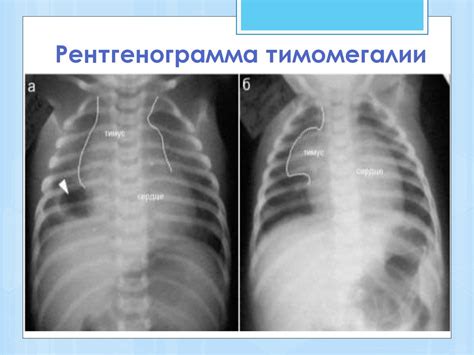 Вилочковая железа Online Presentation