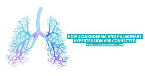 How Scleroderma And Pulmonary Hypertension Are Connected Scleroderma News