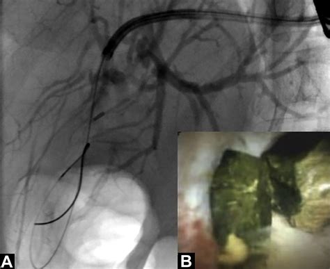 Eus Guided Hepaticogastrostomy For Management Of Cholangitis Hepatolithiasis And Anastomotic