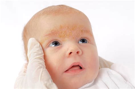 410 Dermatitis Seboroik Foto Foto Foto Stok Potret And Gambar Bebas