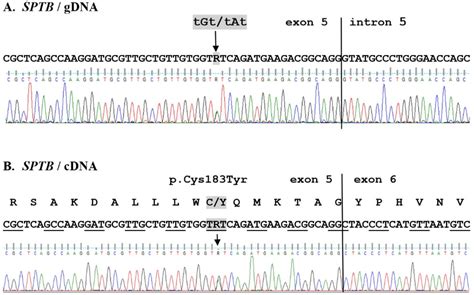 New Sptb Mutation Associated With Hereditary Spherocytosis Fragment Of