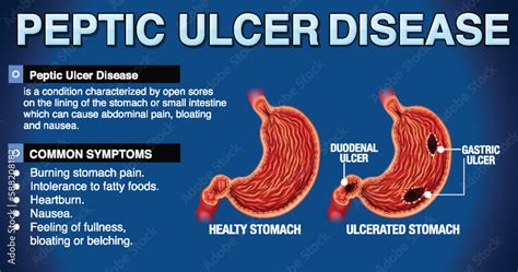 Peptic Ulcer Disease Explained Infographic Stock Vector Adobe Stock
