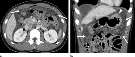 Peritoneum Definition And Examples Biology Online Dictionary