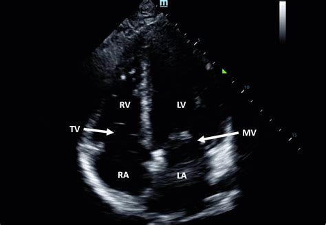 Cardiac Views Toronto Internal Medicine Pocus