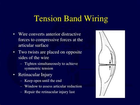 Types Of Tension Band Wiring At Geraldine Williamson Blog