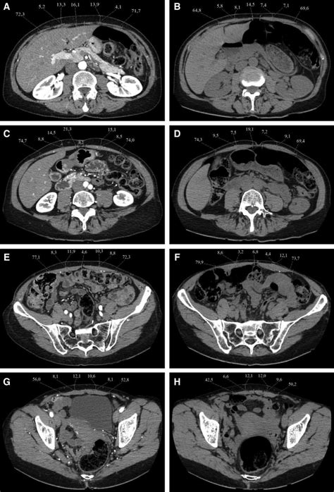 Preoperative Left And Postoperative Right Measurements Of All 4