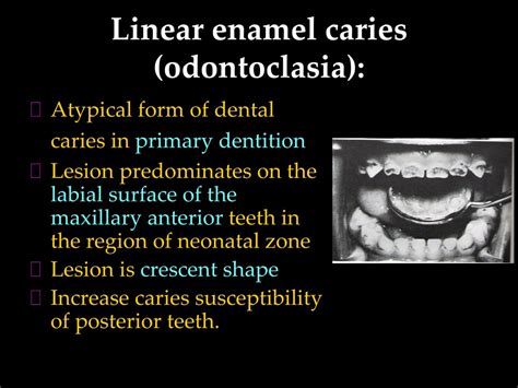 PPT DENTAL CARIES PowerPoint Presentation Free Download ID 9124776