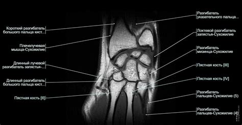Анатомия запястья МРТ нормальная анатомия E Anatomy