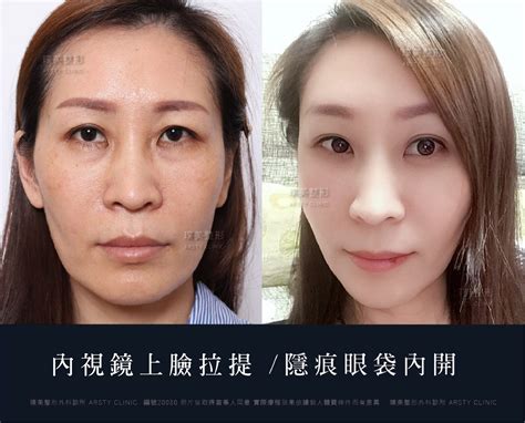拉皮手術恢復期要多久？能7 14天快速恢復的秘訣璞美整形外科
