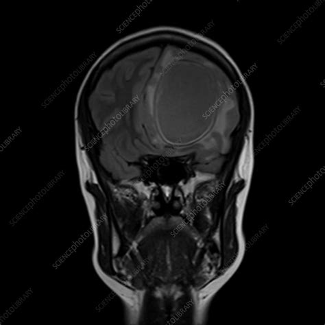 Brain Abscess Mri Sequence Stock Video Clip K0039637 Science