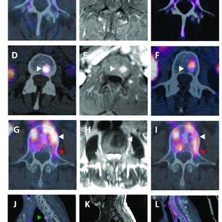 Distribution Of Detected Lesions Within Vertebral Segments In All