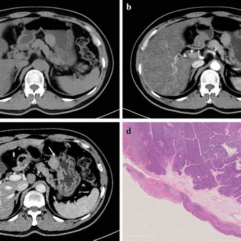 Patient 2 4050 Years Old Sex1 Ectopic Pancreas In Gastric Body