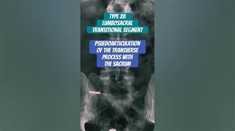 Lumbosacral Transitional Segment ⚕️ Radiology Spine Doctor Youtube
