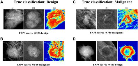 Deep Learning Enabled Fully Automated Pipeline System For Segmentation And Classification Of