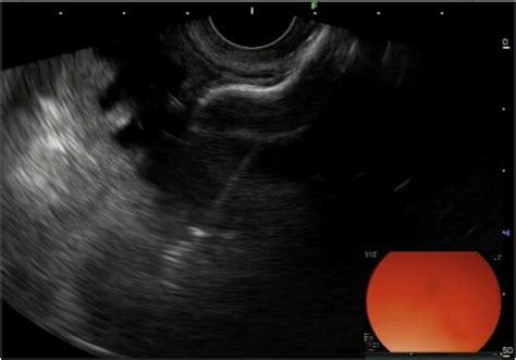 Stent Deployment After Reinsertion Of The Electrocautery Enhanced Download Scientific Diagram