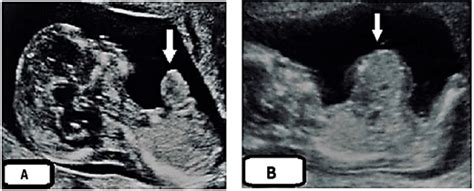 Complete Thoracic Ectopia Cordis Dilemma Of The Outcome A Case Report