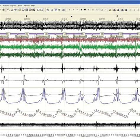 Periodic Breathing Part Of A Polysomnographic Recording Lasting 5