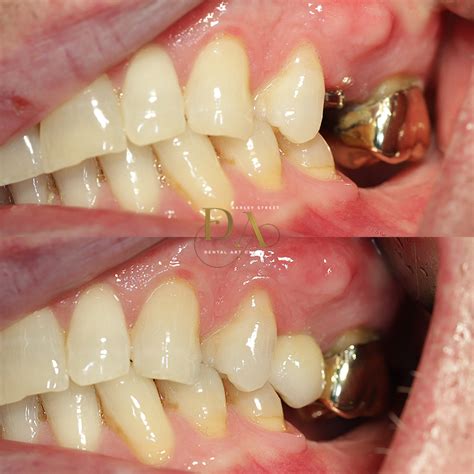 Dental Implants Dental Art Clinic