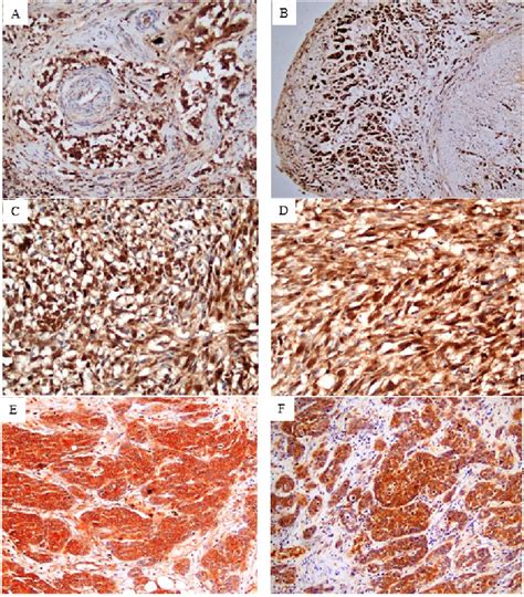 Tumor Cells Showed Variability In Nuclear Expression According To The