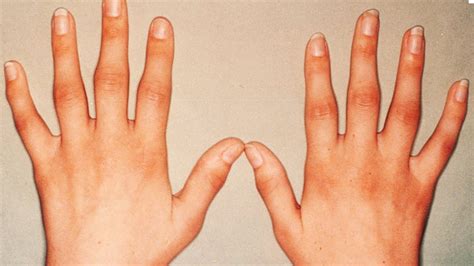 Arthritis And Ayurvedic Treatment Youtube