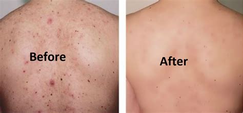 Acne On Back Causes