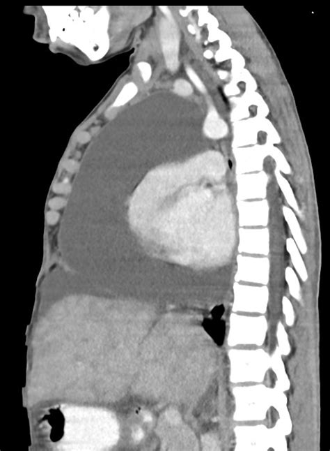 File Massive Pericardial Effusion Nutmeg Liver Radiopaedia 78354