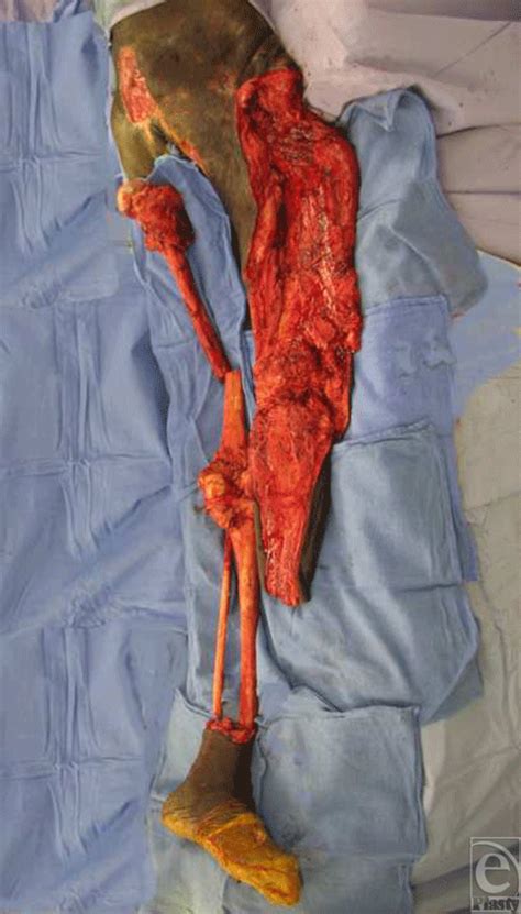 Traumatic Hemicorporectomy