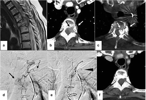Jvir Access Transarterial Chemoembolization For The Palliation Of