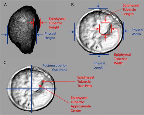 Auricular Tubercle Semantic Scholar