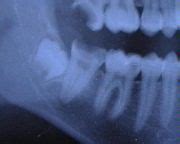 Wisdom Tooth Wikimedia Commons