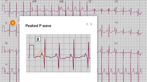 Ventricular Septal Defect Ecg Ventricular Septal Defect Vsd