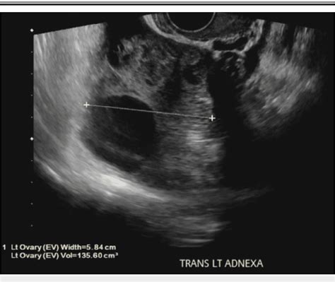 Figure 4 From A Case Of Severe Ovarian Hyperstimulation Syndrome