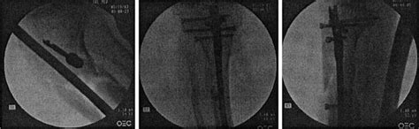 Extremely Proximal Tibial Frature For Which A Blocking Screw Was Download Scientific Diagram
