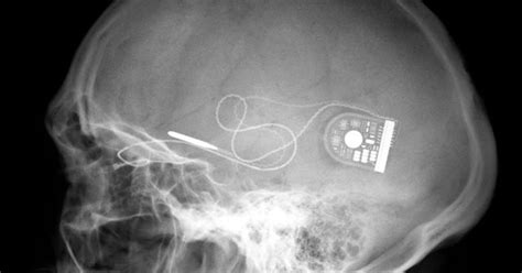 Eye Implants Restore Vision In Two British Patients Cbs News