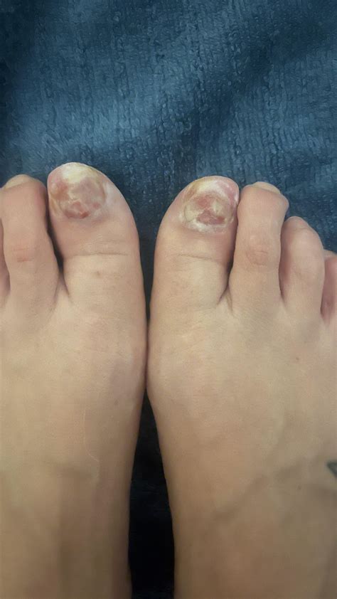 Post Permanent Toenail Removal Ringrowntoenails