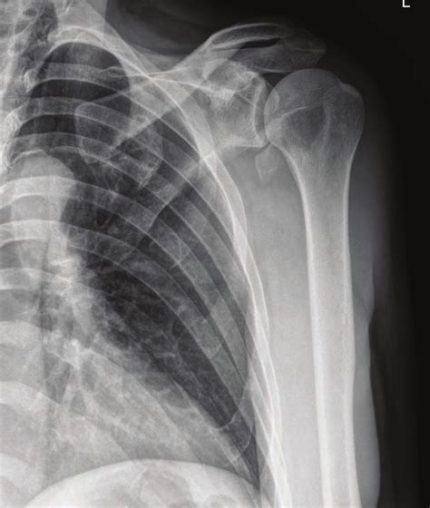 Anteroposterior Radiograph Of The Left Shoulder Shows The Displaced Download Scientific Diagram