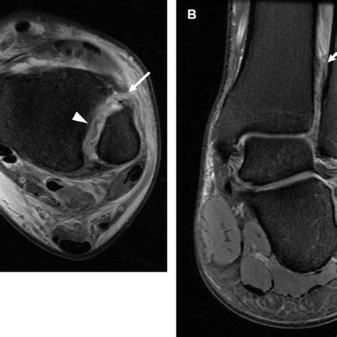 Schneck Grading System And Sikka Classification For Grading Of The