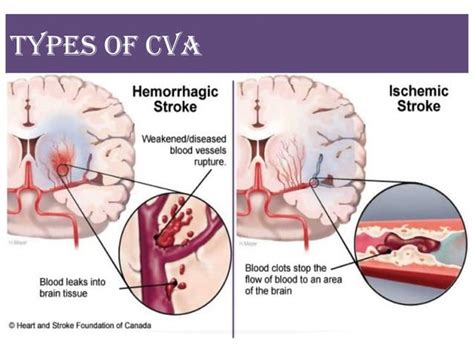Cva Cerebrovascular Accident Stroke Ppt