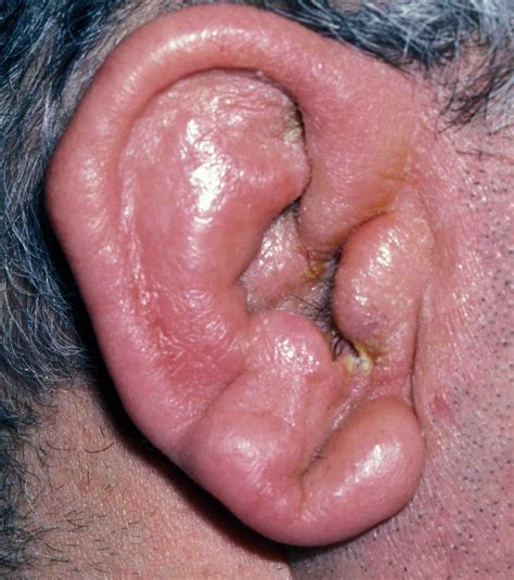 Otitis Externa Maligna Otitis Externa Practice Essentials