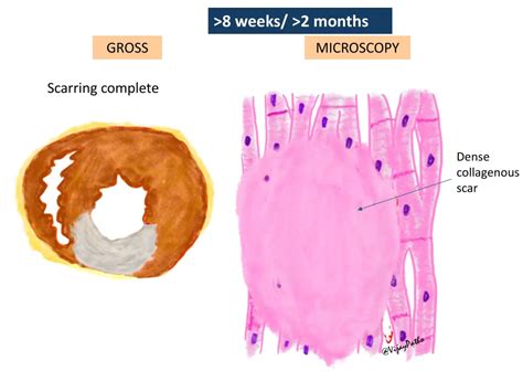 Myocardial Infarction Gross And Microscopy Pathology Made Simple