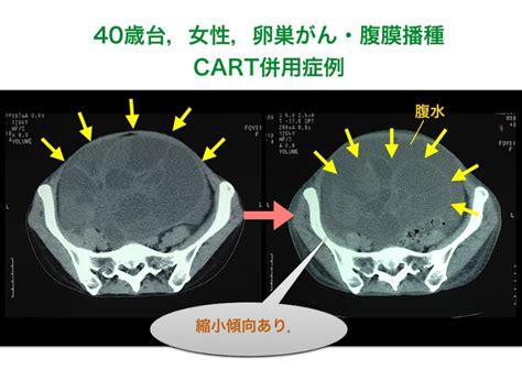 卵巣がん・cart併用症例 「あとは緩和」といわれたら
