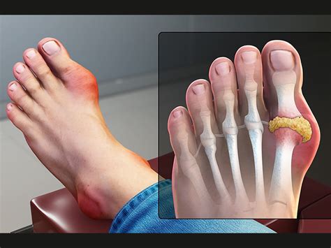 Gouty Arthritis Foundation For Alternative And Integrative Medicine