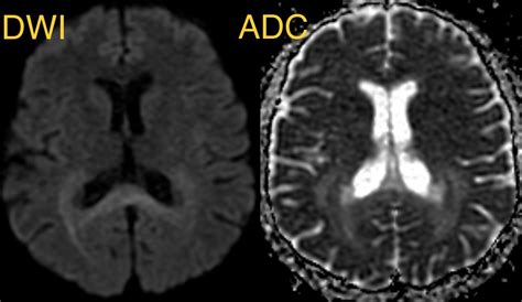 What Is The Most Likely Diagnosis In This 40 Yo M With Hx Of