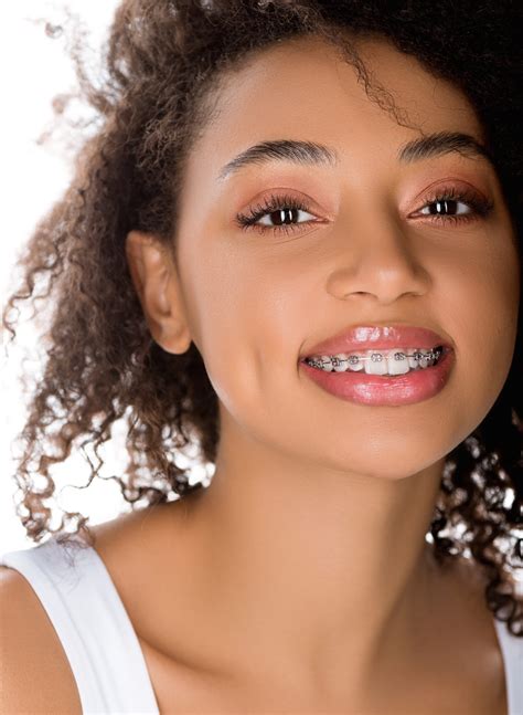 Single Arch Braces Treatment A Perfect Smile Orthodontics