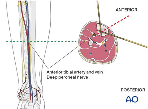Safe Zones In The Tibia For Pin Insertion