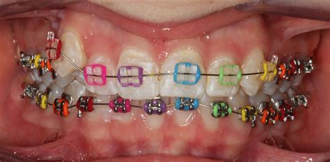 Braces Power Chain Colors Braces Colors Cute Braces Power Chain Braces