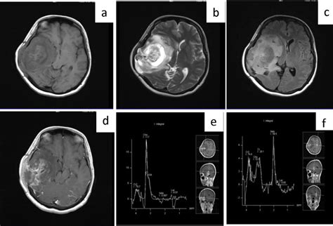 Conventional Mri And Mr Spectroscopy Of Patient With Diffuse Download Scientific Diagram